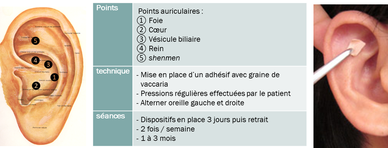 67- Traitement par acupuncture de la dépression : recommandations de ...