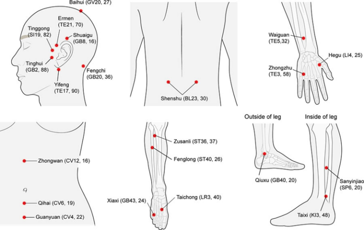 114- Traitement par acupuncture des acouphènes : examen de la portée. - Gera